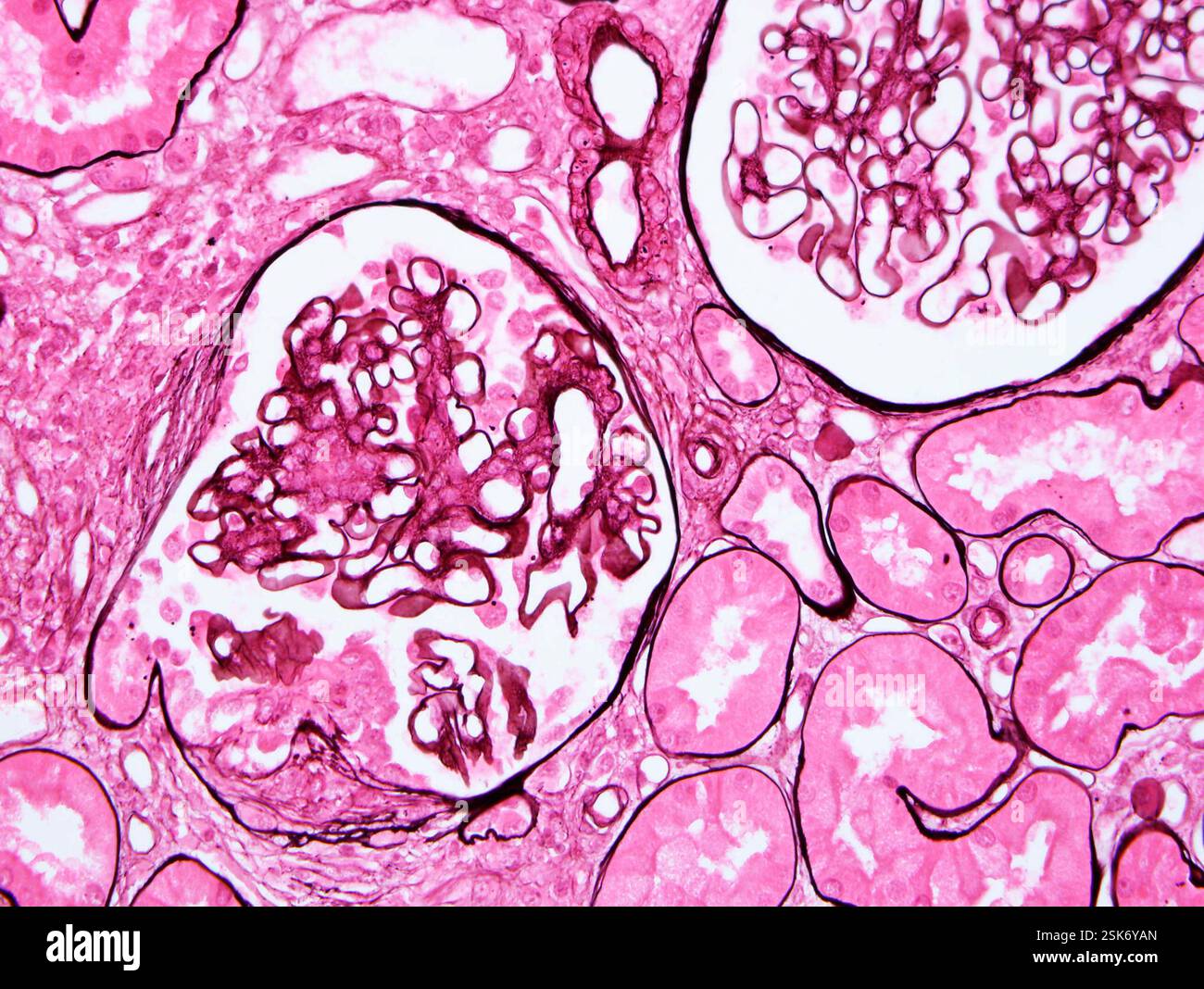 Segmental glomerulonephritis. Light micrograph of a section through two ...