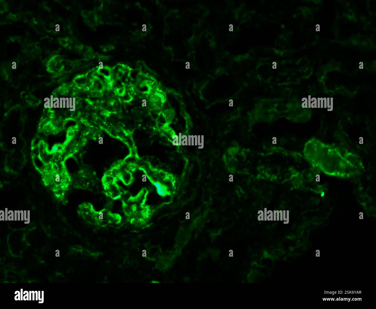 Lupus nephritis. Immunofluorescence Iight micrograph of a glomerulus, a ...