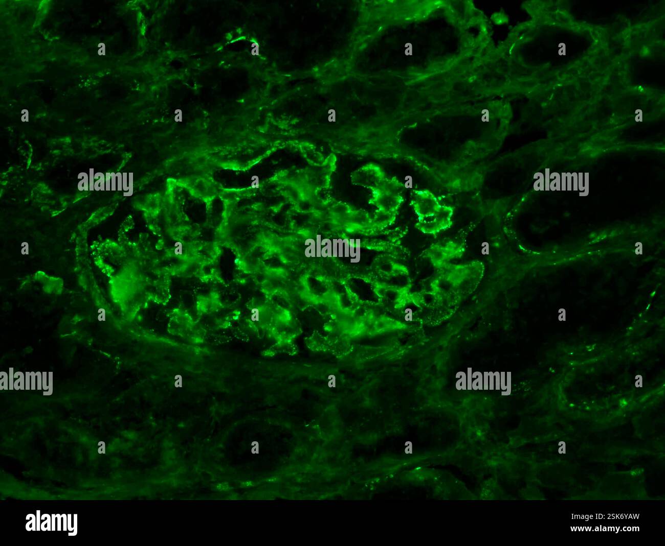 Lupus nephritis. Immunofluorescence Iight micrograph of a glomerulus, a ...