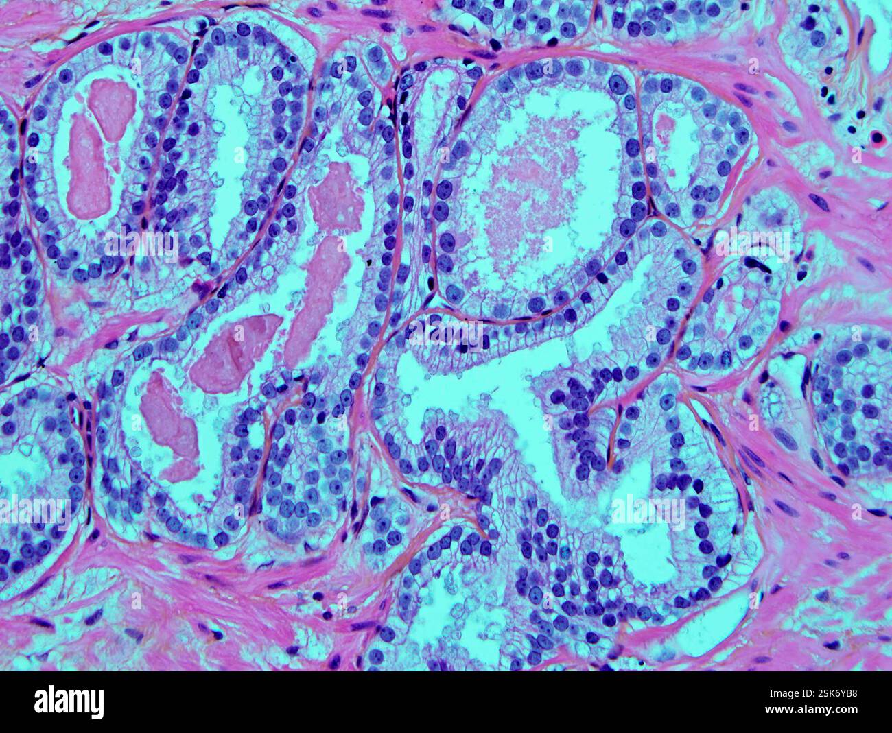 Prostate cancer. Light micrograph of a section through a prostate gland ...