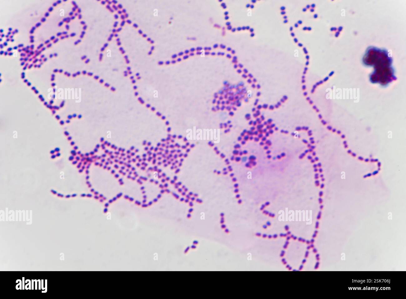 Streptococcus bacteria. Light micrograph of sputum (mucus coughed up ...