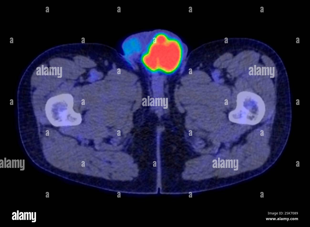 Pancreatic cancer, CT and PET scans Stock Photo - Alamy