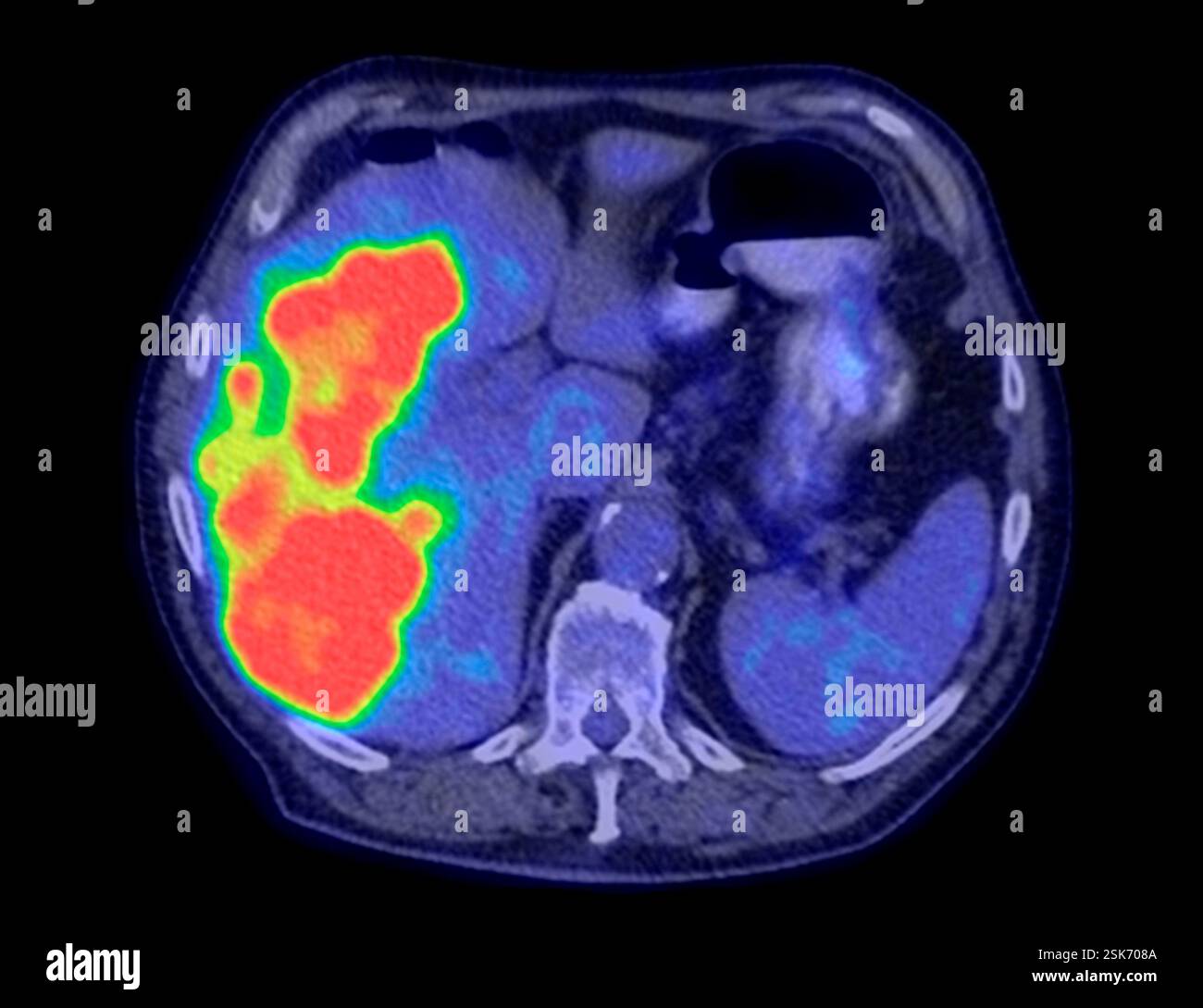 Secondary liver cancer. Coloured combined computed tomography (CT) and positron-emission ...