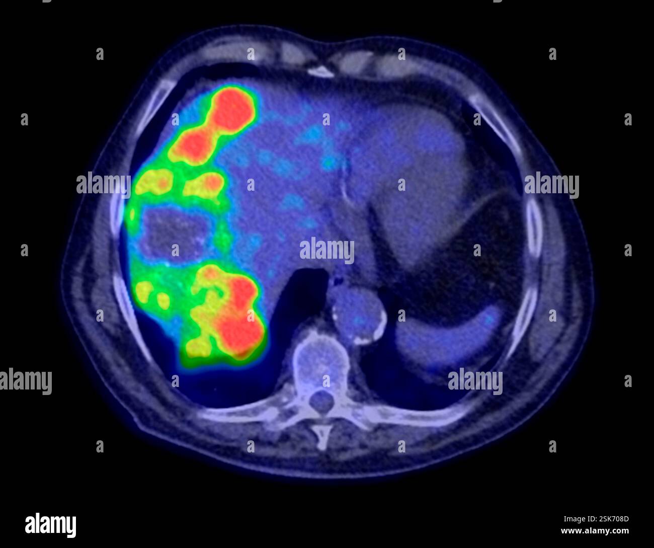 Secondary liver cancer. Coloured combined computed tomography (CT) and positron-emission ...
