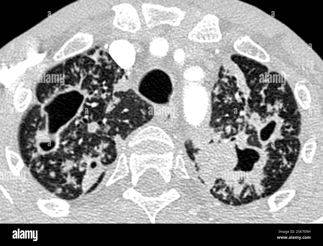 Tuberculosis. Computed tomography (CT) scan of a 29-year-old male patient affected by severe ...