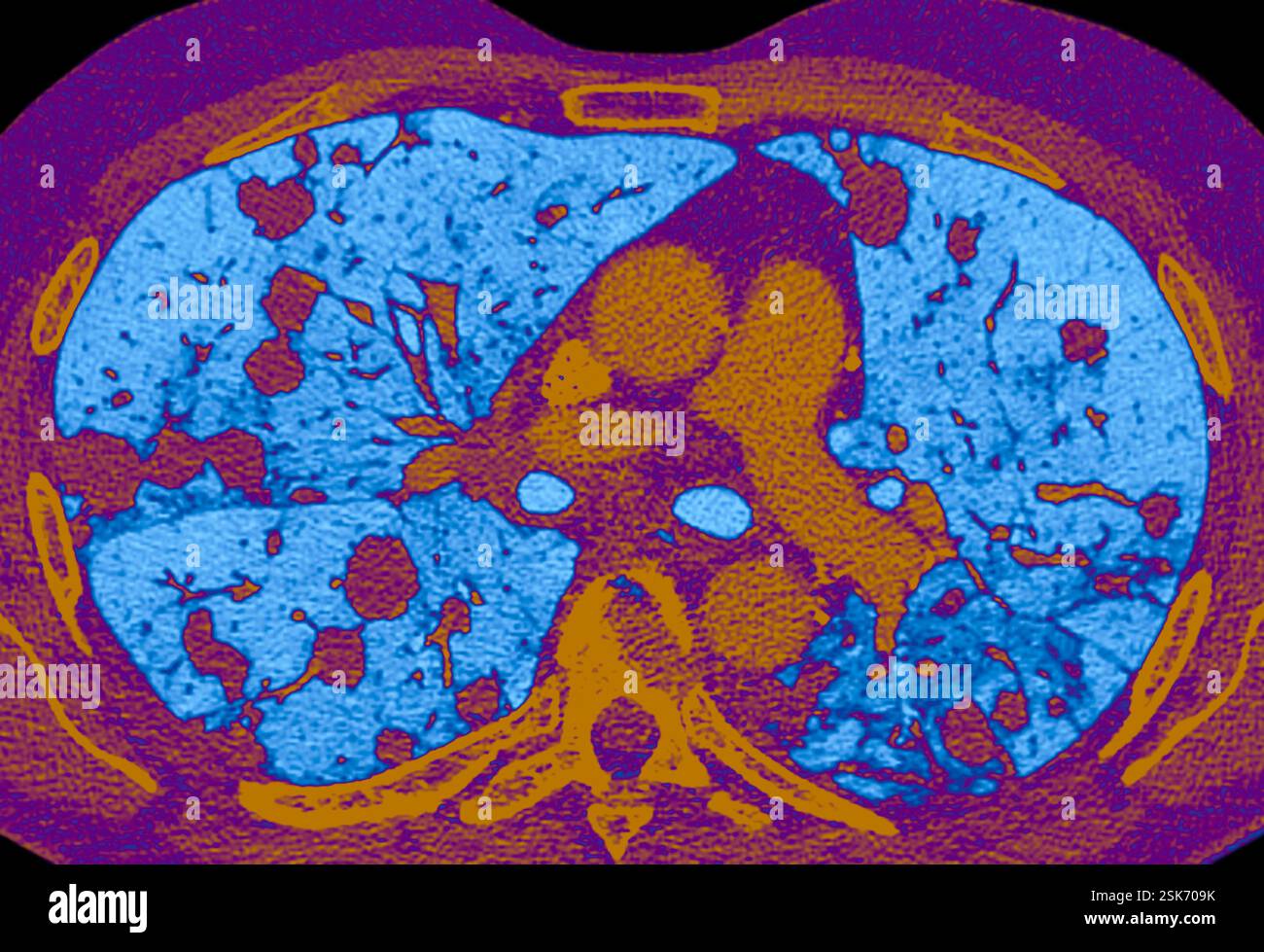 Secondary lung cancer. Coloured computed tomography (CT) scan of an axial section through the ...