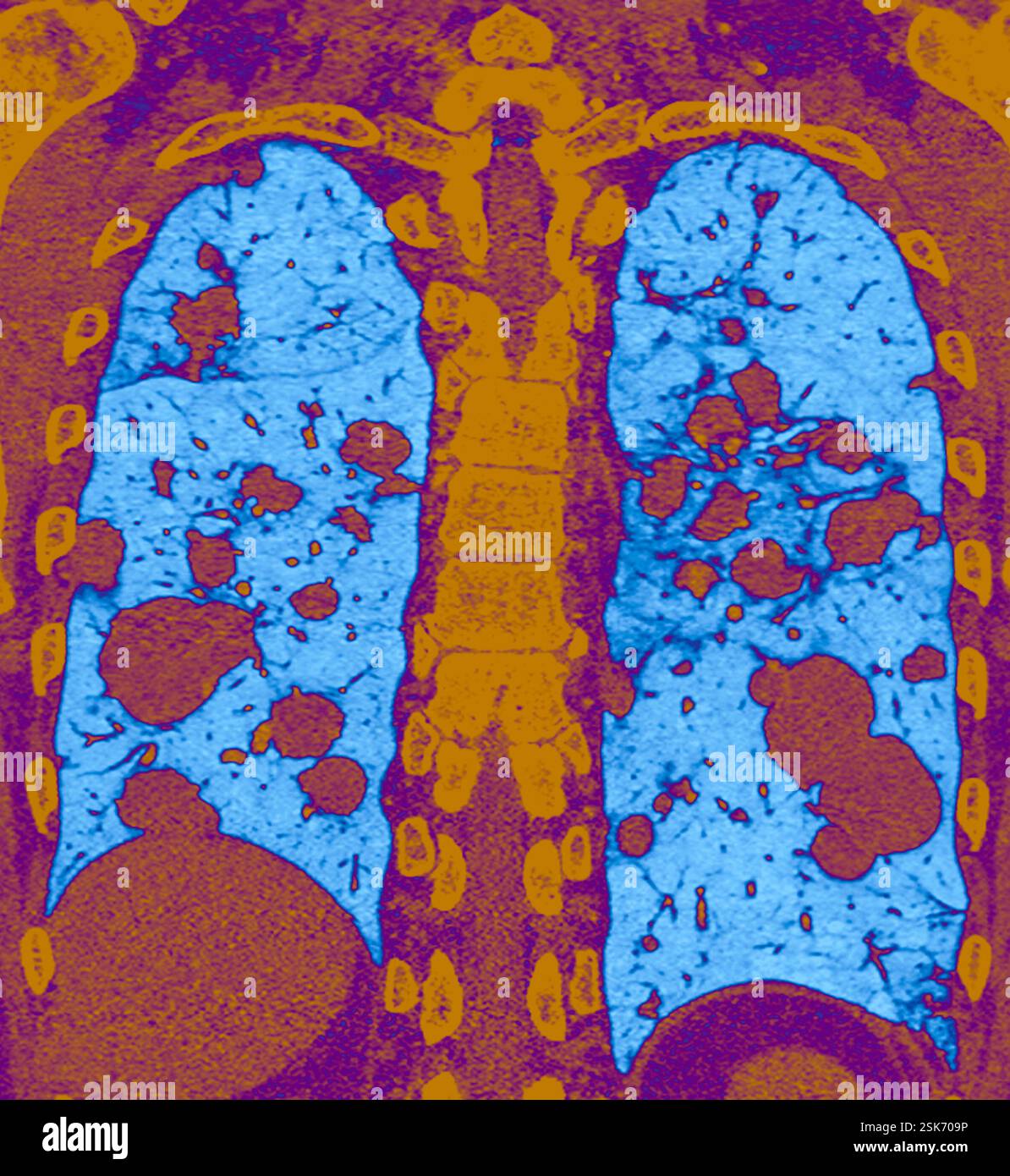 Secondary lung cancer. Coloured computed tomography (CT) scan of a coronal section through the ...