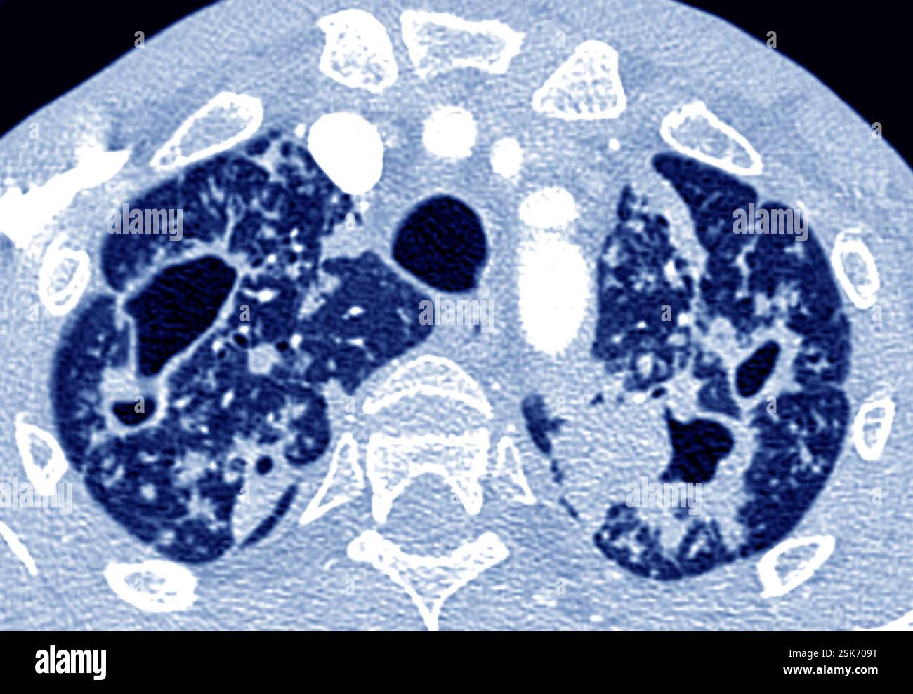 Tuberculosis. Coloured computed tomography (CT) scan of a 29-year-old ...