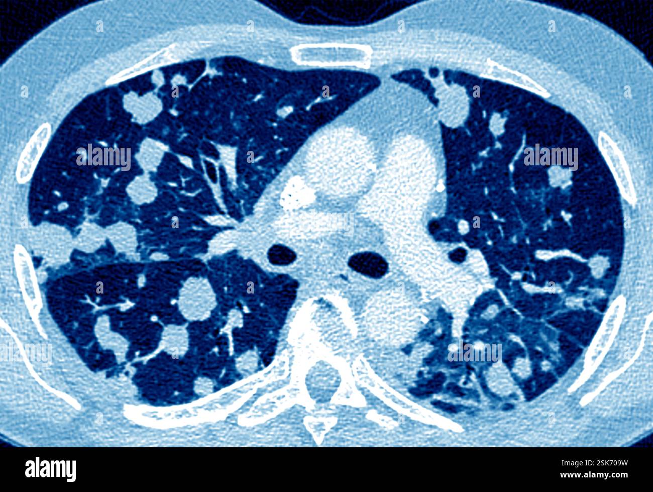 Secondary cancer. Coloured computed tomography (CT) scan of an axial section through the lungs ...