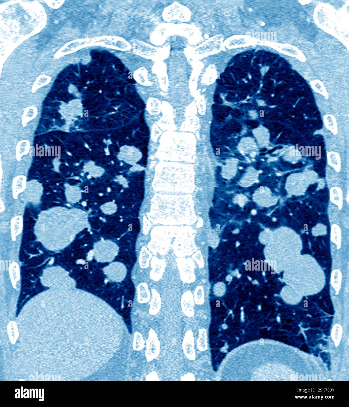 Secondary lung cancer. Coloured computed tomography (CT) scan of a coronal section through the ...