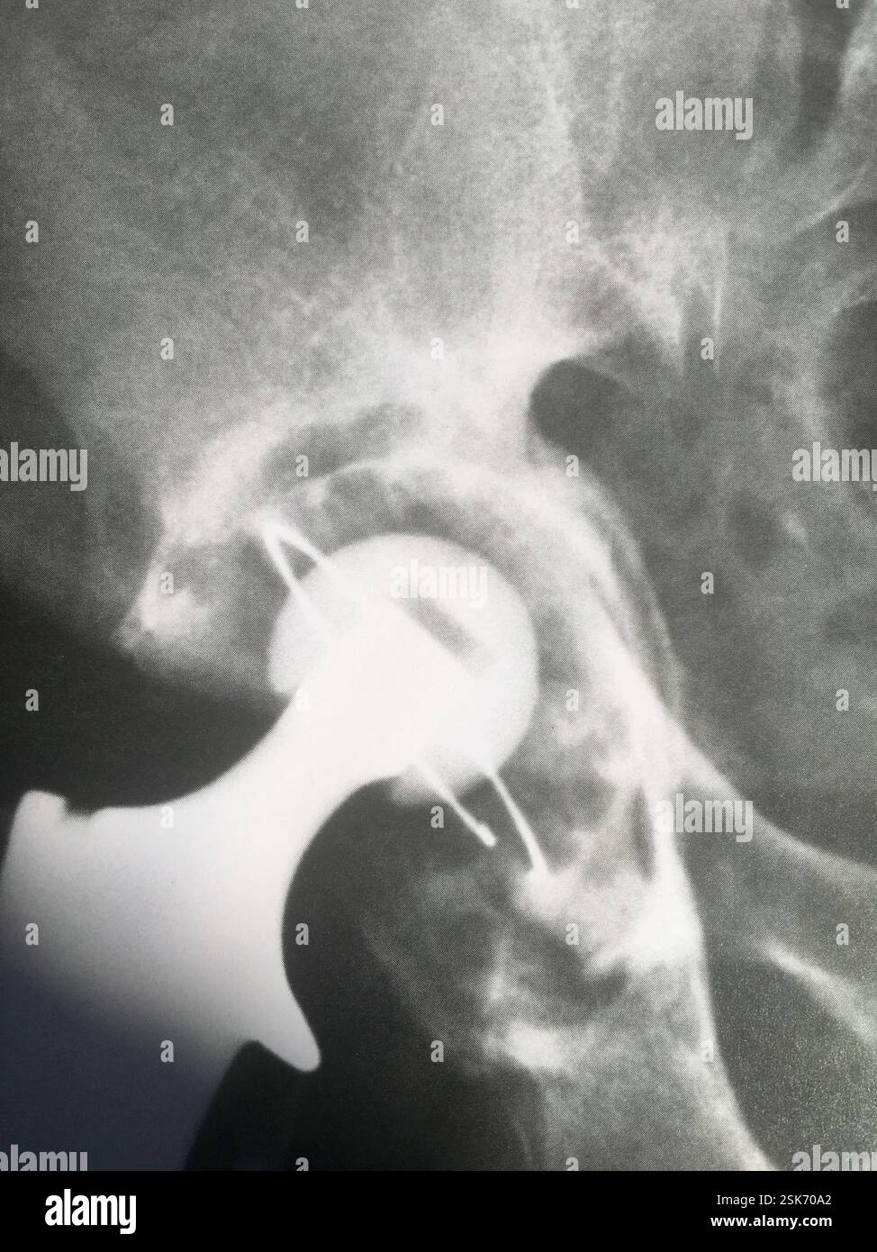 Damaged hip replacement. X-ray of the right hip of a 68-year-old male ...