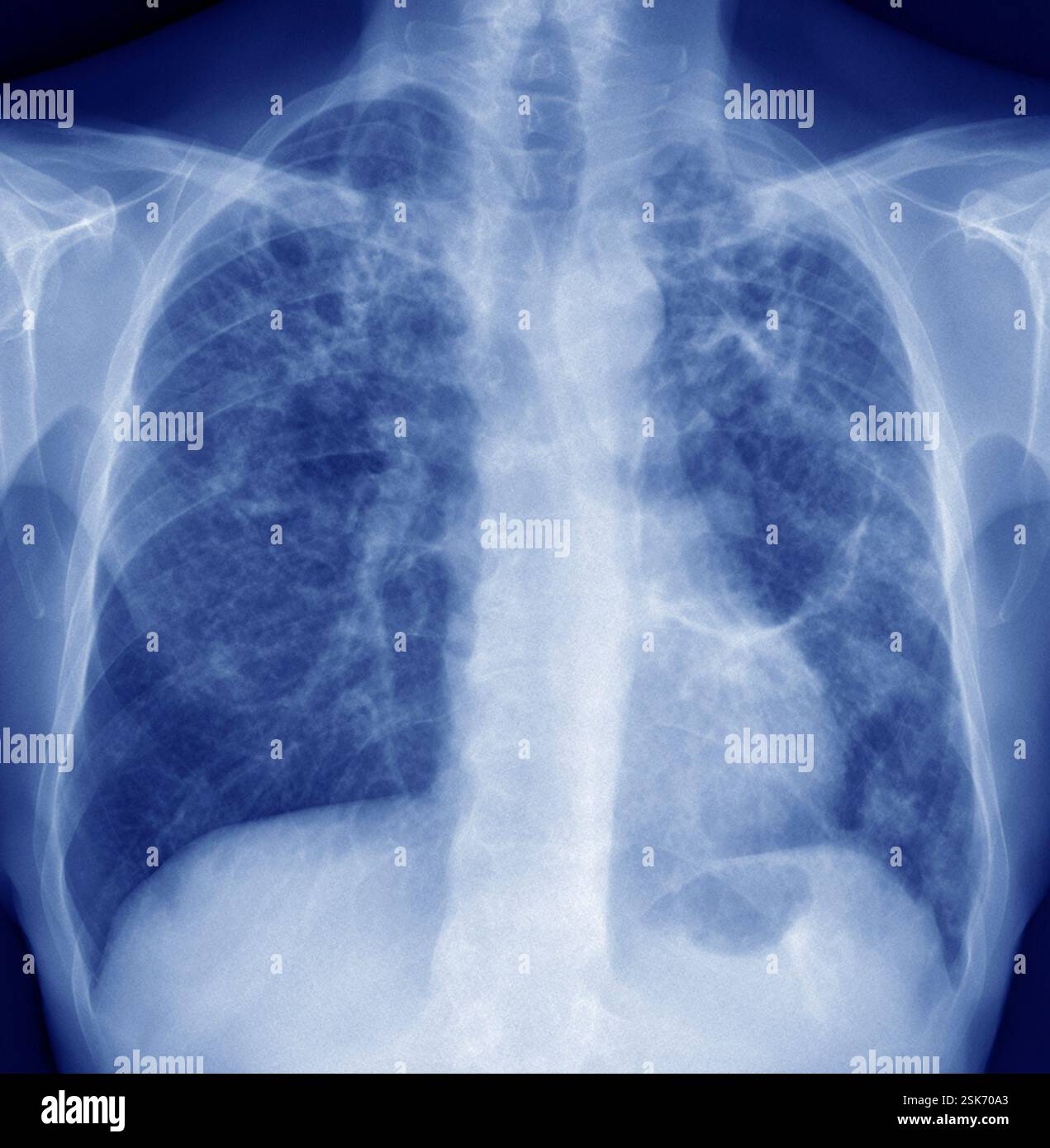 Tuberculosis. Coloured chest X-ray of a 29-year-old male patient ...