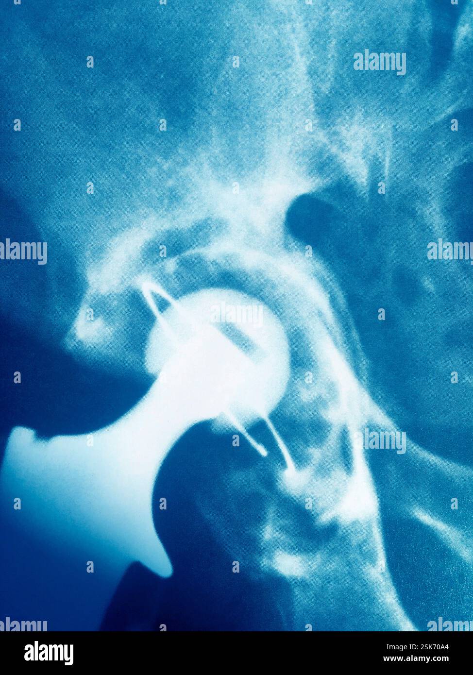 Damaged hip replacement. Coloured X-ray of the right hip of a 68-year ...