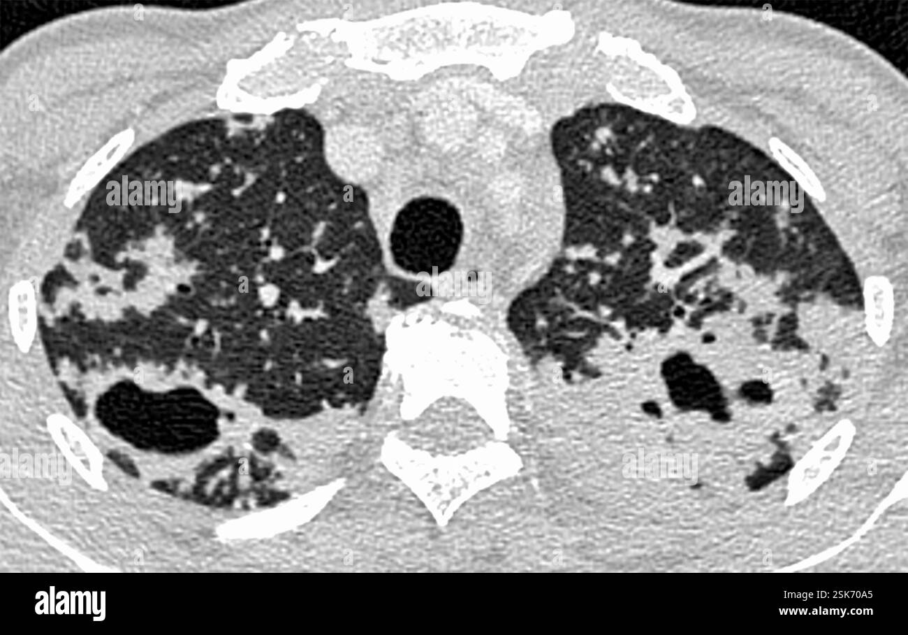 Tuberculosis. Computed tomography (CT) scan of a 48-old male patient ...