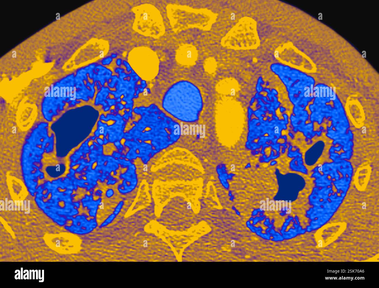 Tuberculosis. Coloured computed tomography (CT) scan of a 29-year-old ...
