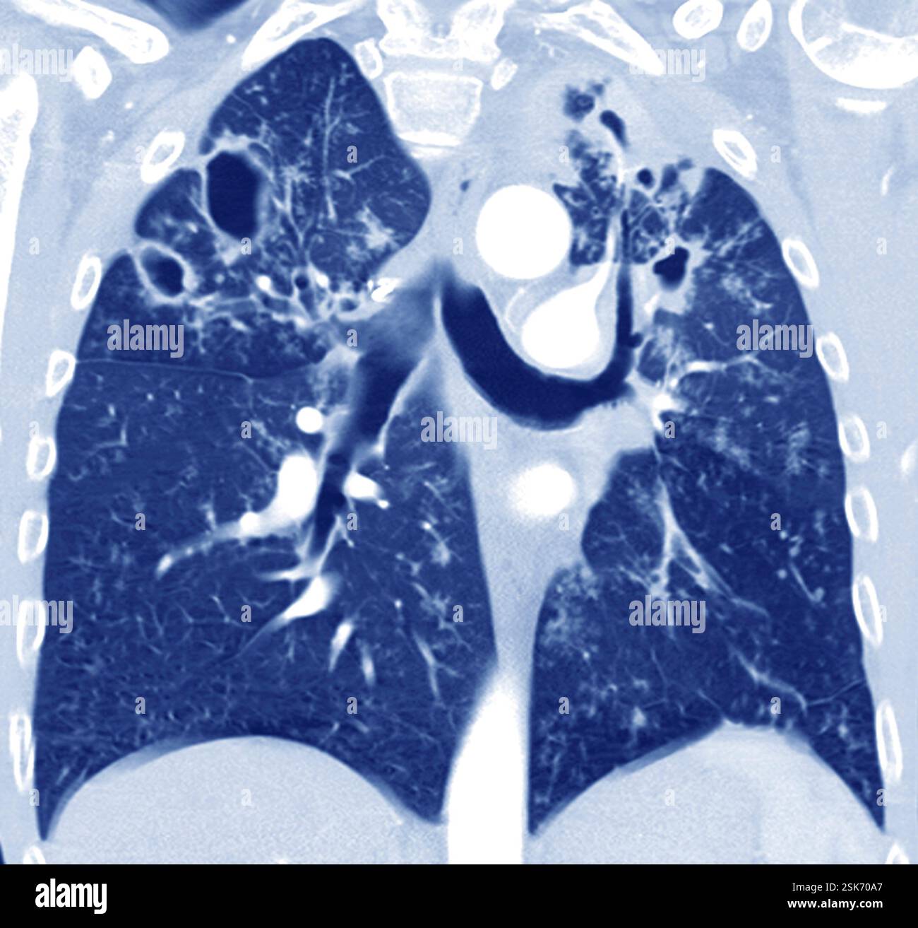 Tuberculosis. Computed tomography (CT) scan of a 29-year-old male patient affected by severe ...