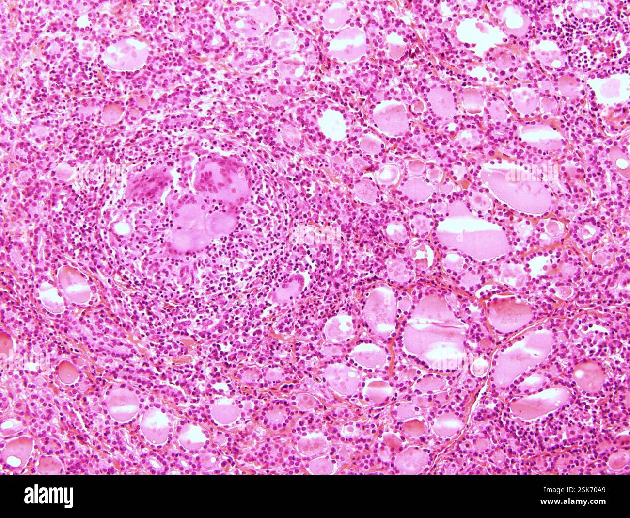 Subacute granulomatous thyroiditis. Light micrograph of a section ...