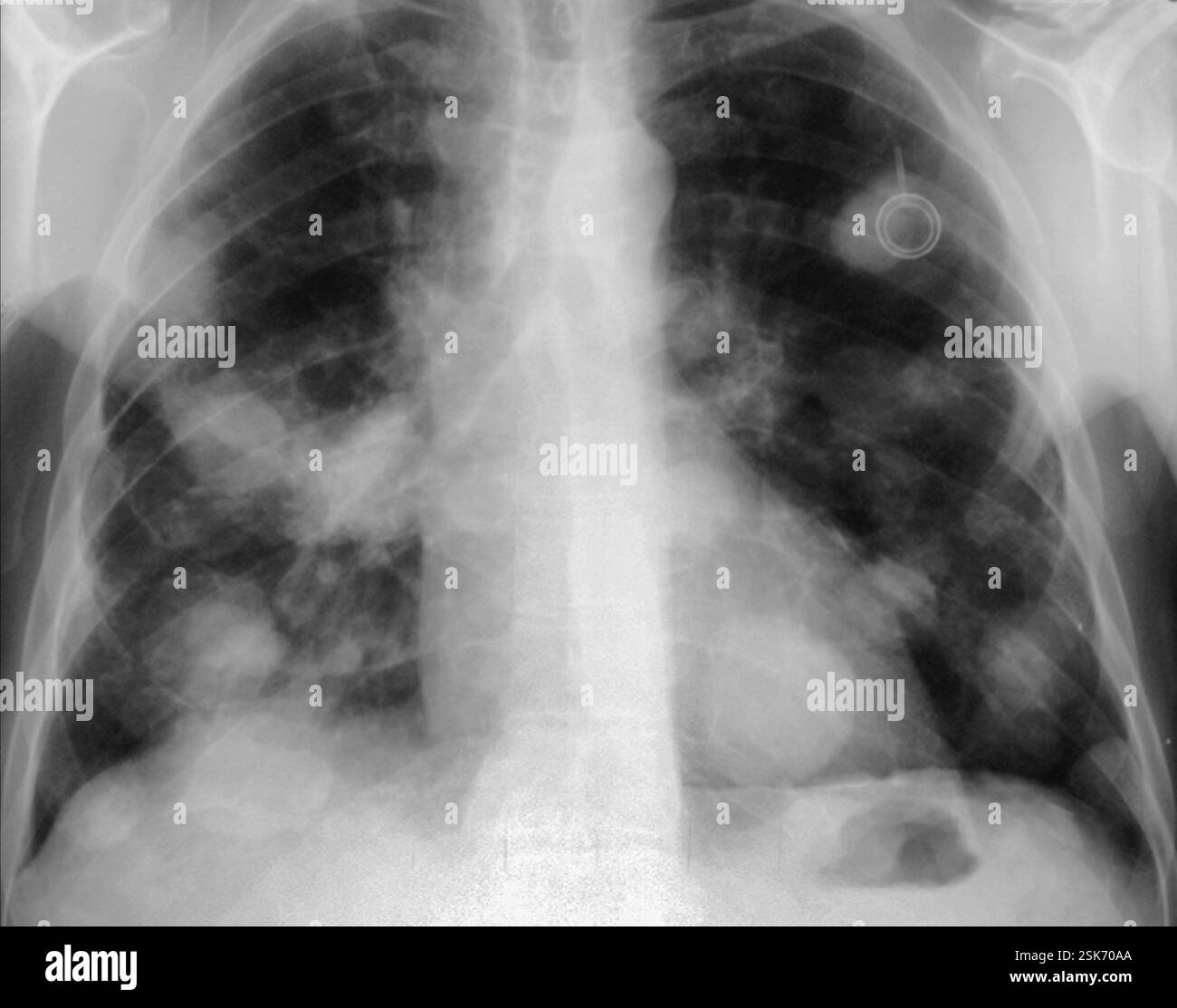 Secondary lung cancer. Chest X-ray of the lungs (dark) of a 23-year-old ...