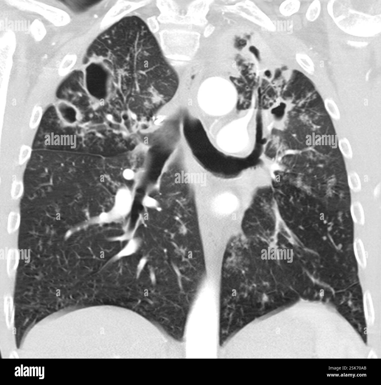 Tuberculosis. Computed tomography (CT) scan of a 29-year-old male ...