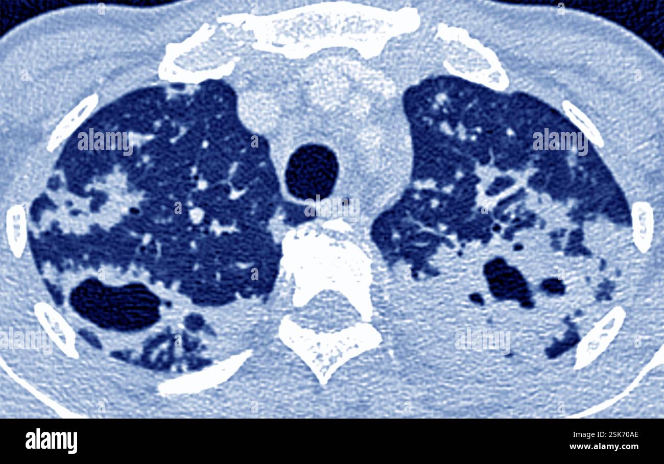 Tuberculosis. Coloured computed tomography (CT) scan of a 48-old male ...