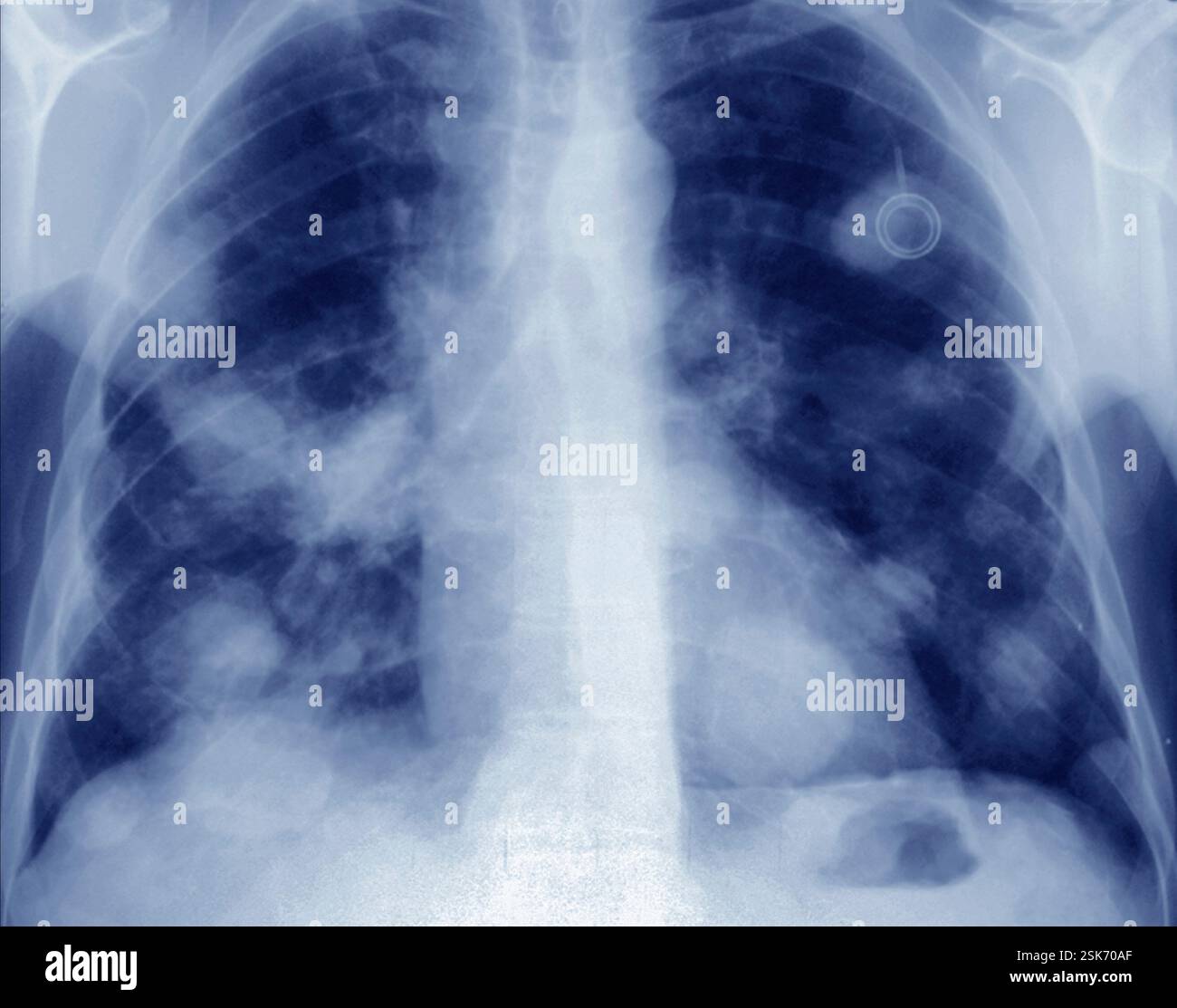 Secondary lung cancer. Coloured chest X-ray of a section through the ...