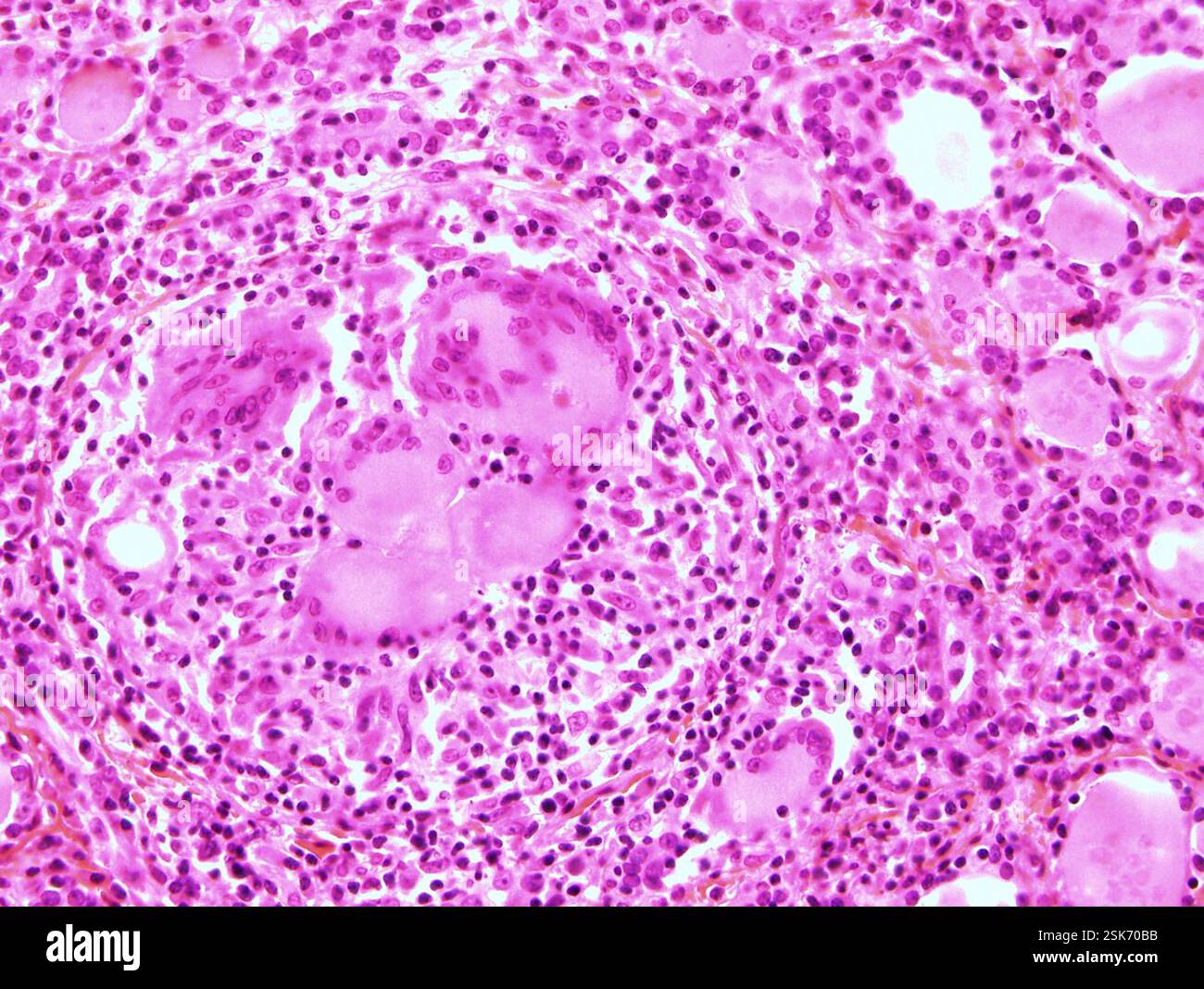 Subacute granulomatous thyroiditis. Light micrograph of a section ...