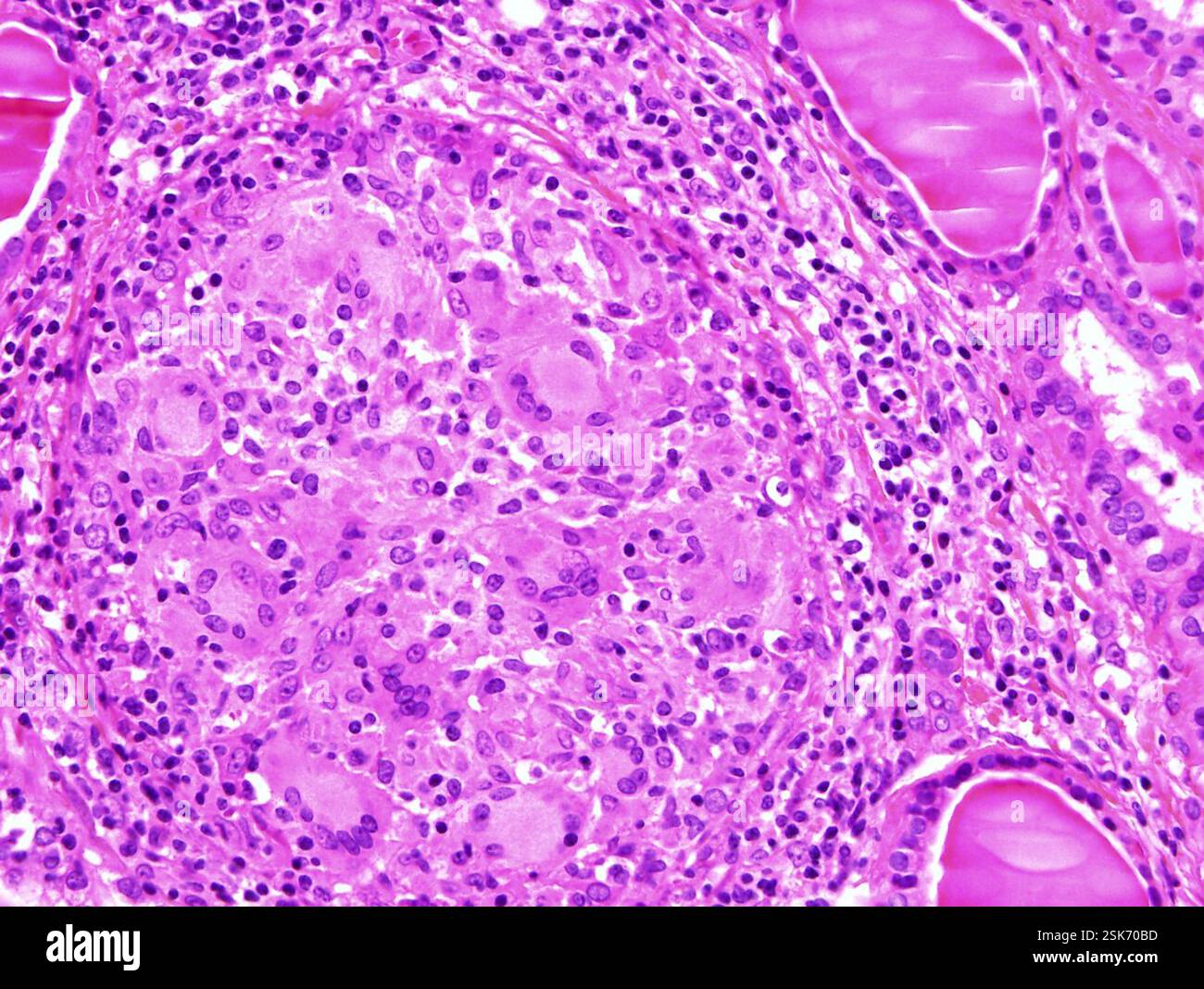 Subacute granulomatous thyroiditis. Light micrograph of a section ...
