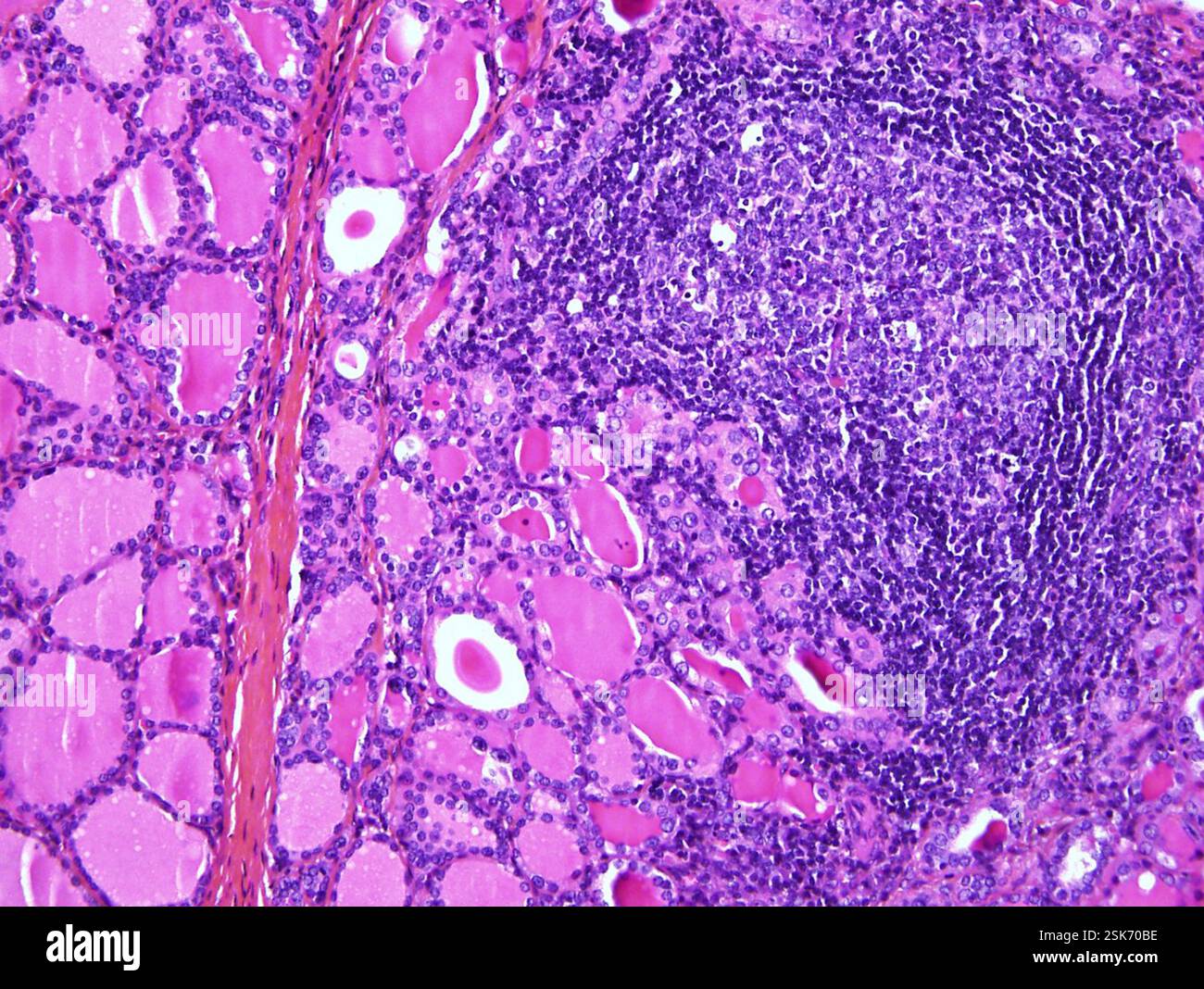 Thyroid in Graves' disease. Light micrograph of a section through the ...
