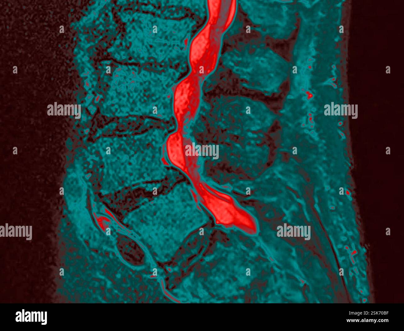 Complex regional pain syndrome, SPECT and CT scans Stock Photo - Alamy