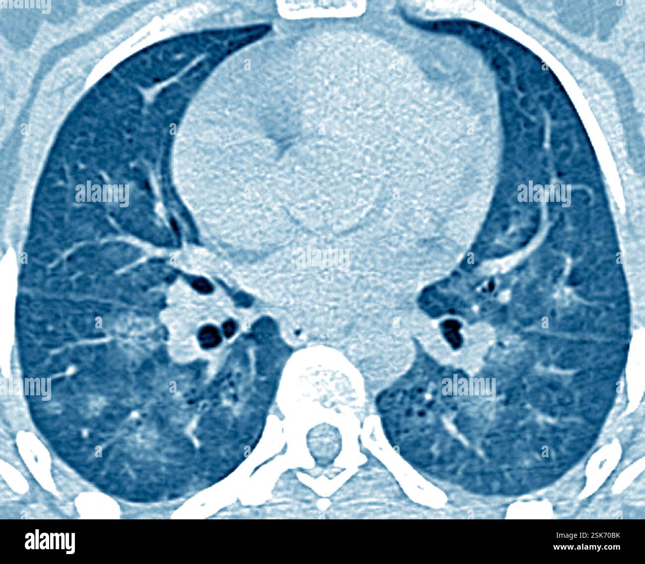 Lung haemorrhage in lupus erythematosus. Computed tomography (CT) scan ...