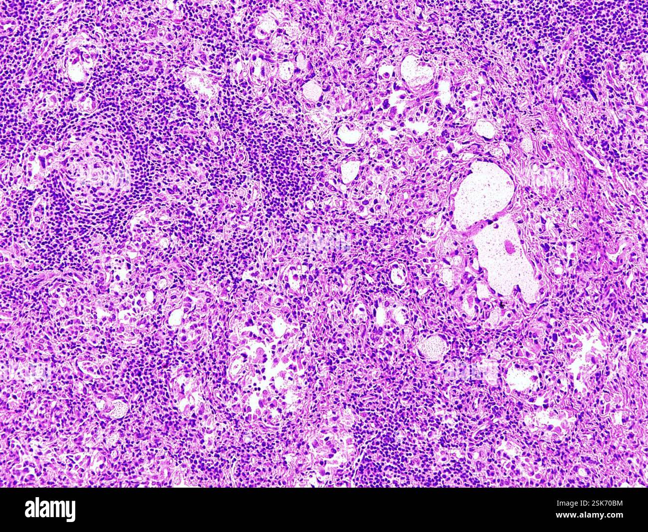 Lymphocytic thyroiditis. Light micrograph of a section through thyroid ...
