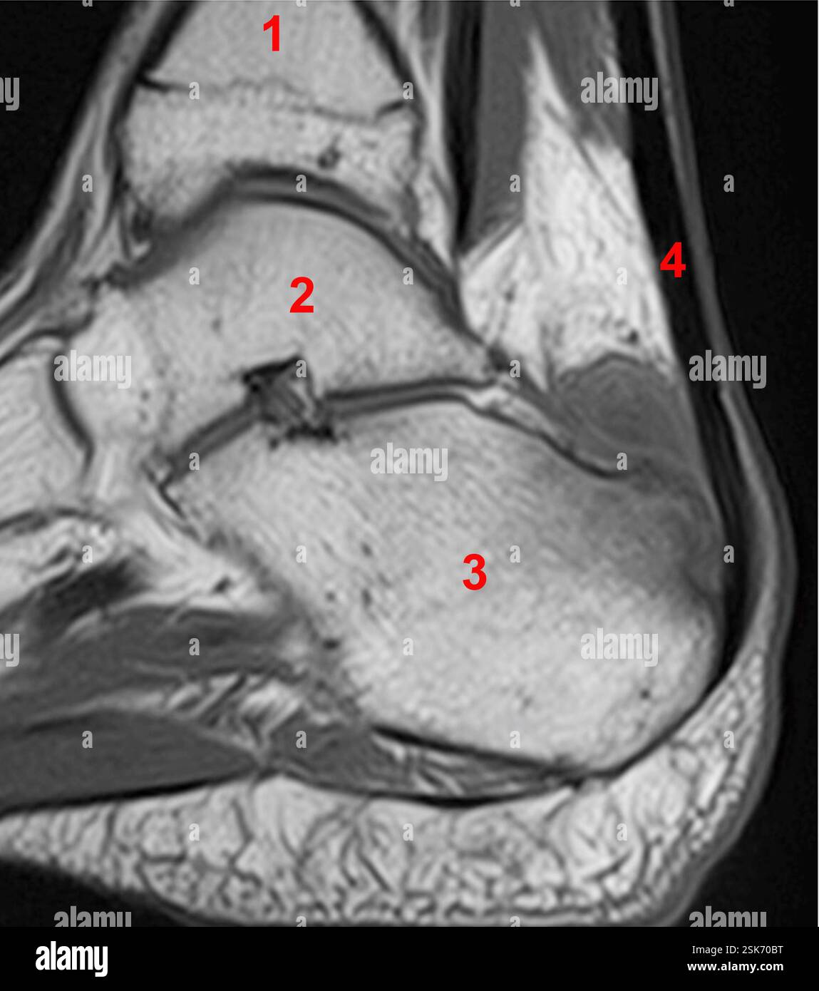 Ankle in spondyloarthritis. Magnetic resonance imaging (MRI) scan of a sagittal section through ...