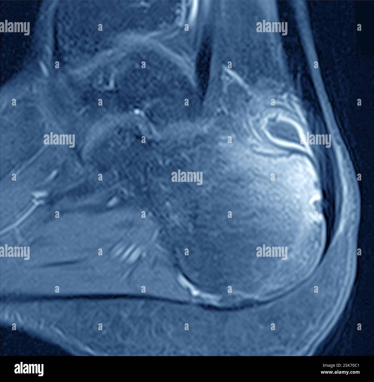 Ankle in spondyloarthritis. Magnetic resonance imaging (MRI) scan of a ...