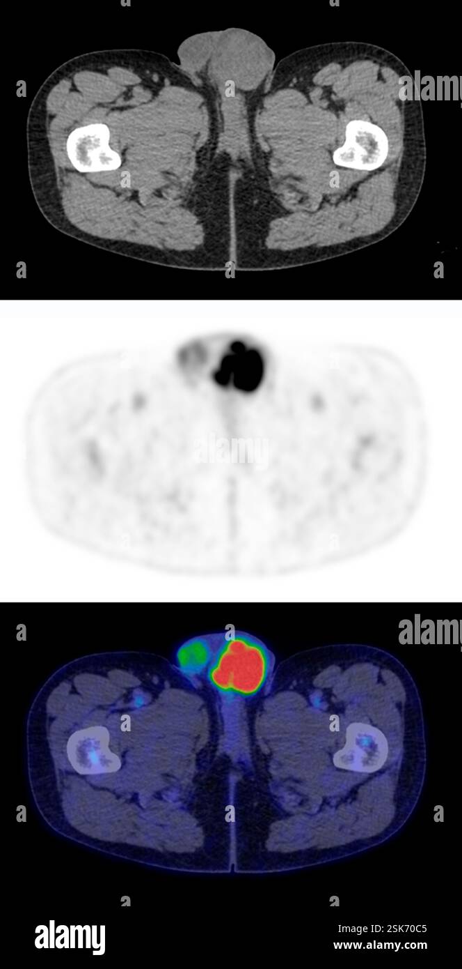Testicular cancer. Computed tomography (CT, top) scan, positron ...