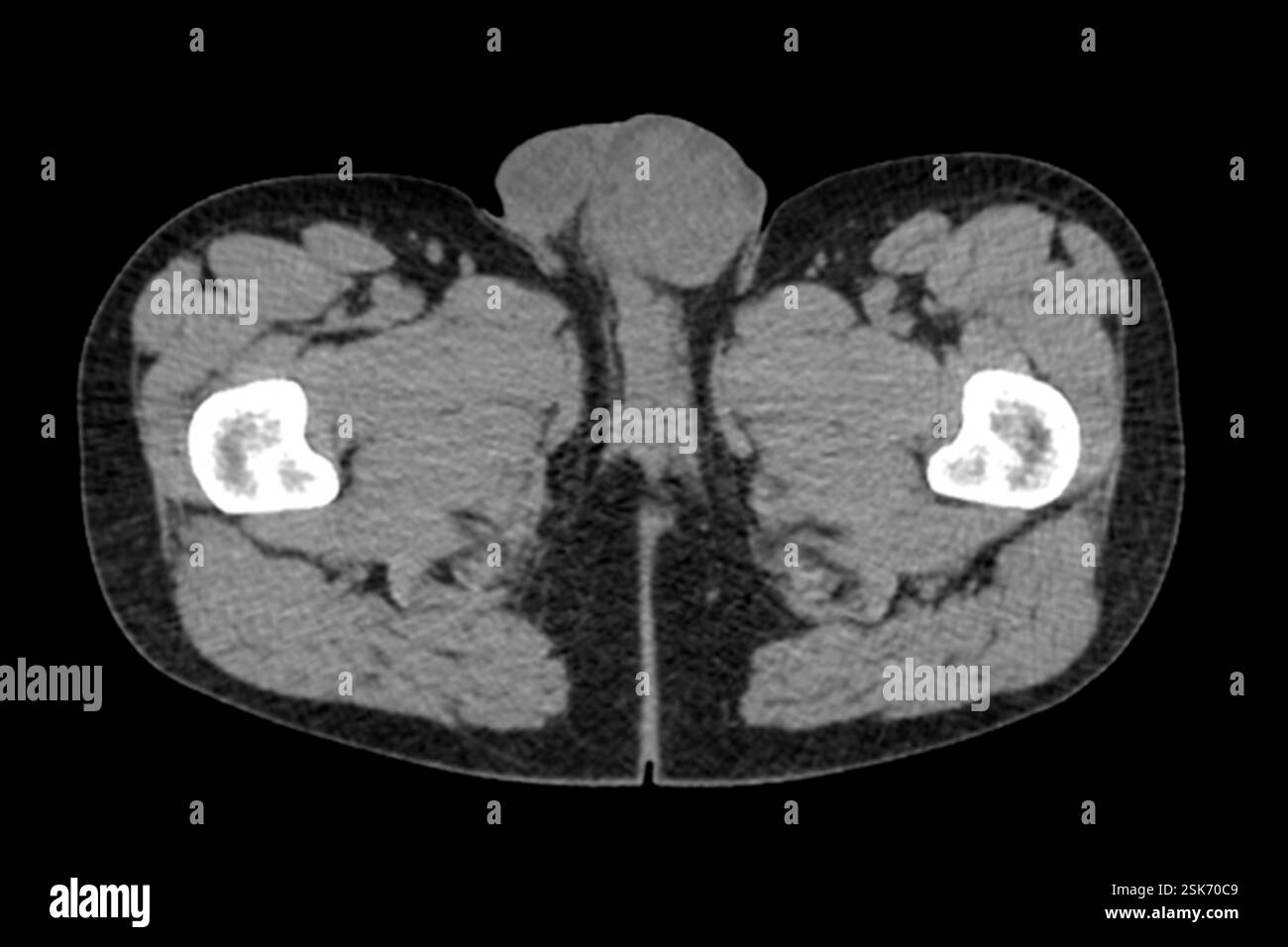 Testicular cancer. Computed tomography (CT) scan of an axial section ...