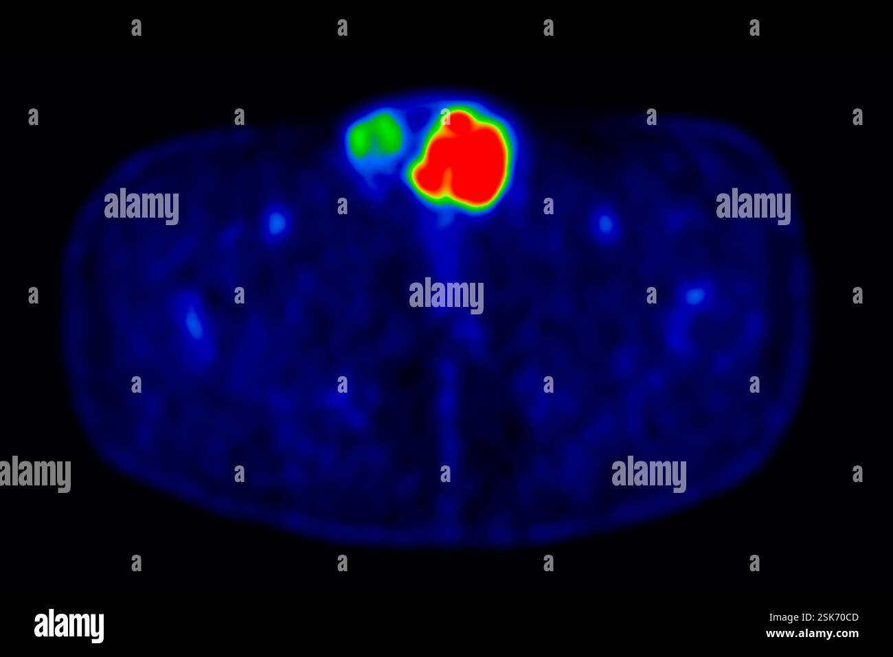 Testicular cancer. Coloured positron-emission tomography (PET, centre ...