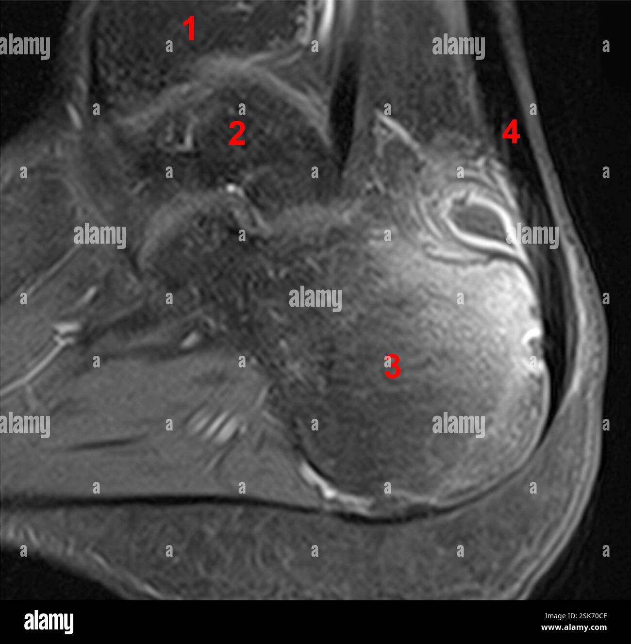 Ankle in spondyloarthritis. Magnetic resonance imaging (MRI) scan of a ...