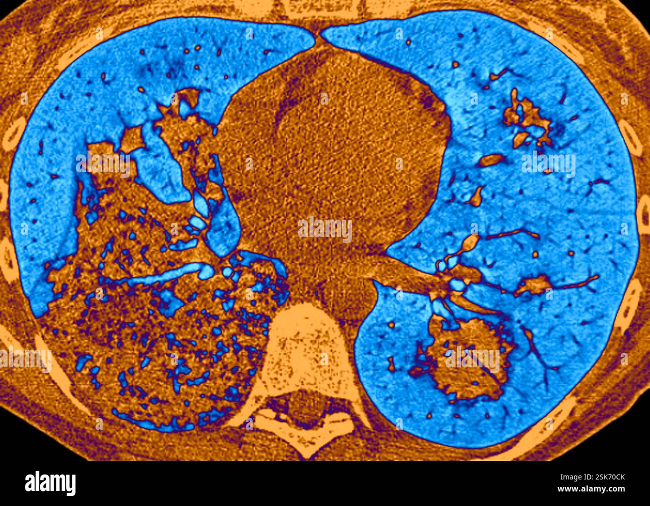 Wegener's granulomatosis. Coloured axial chest computed tomography (CT ...