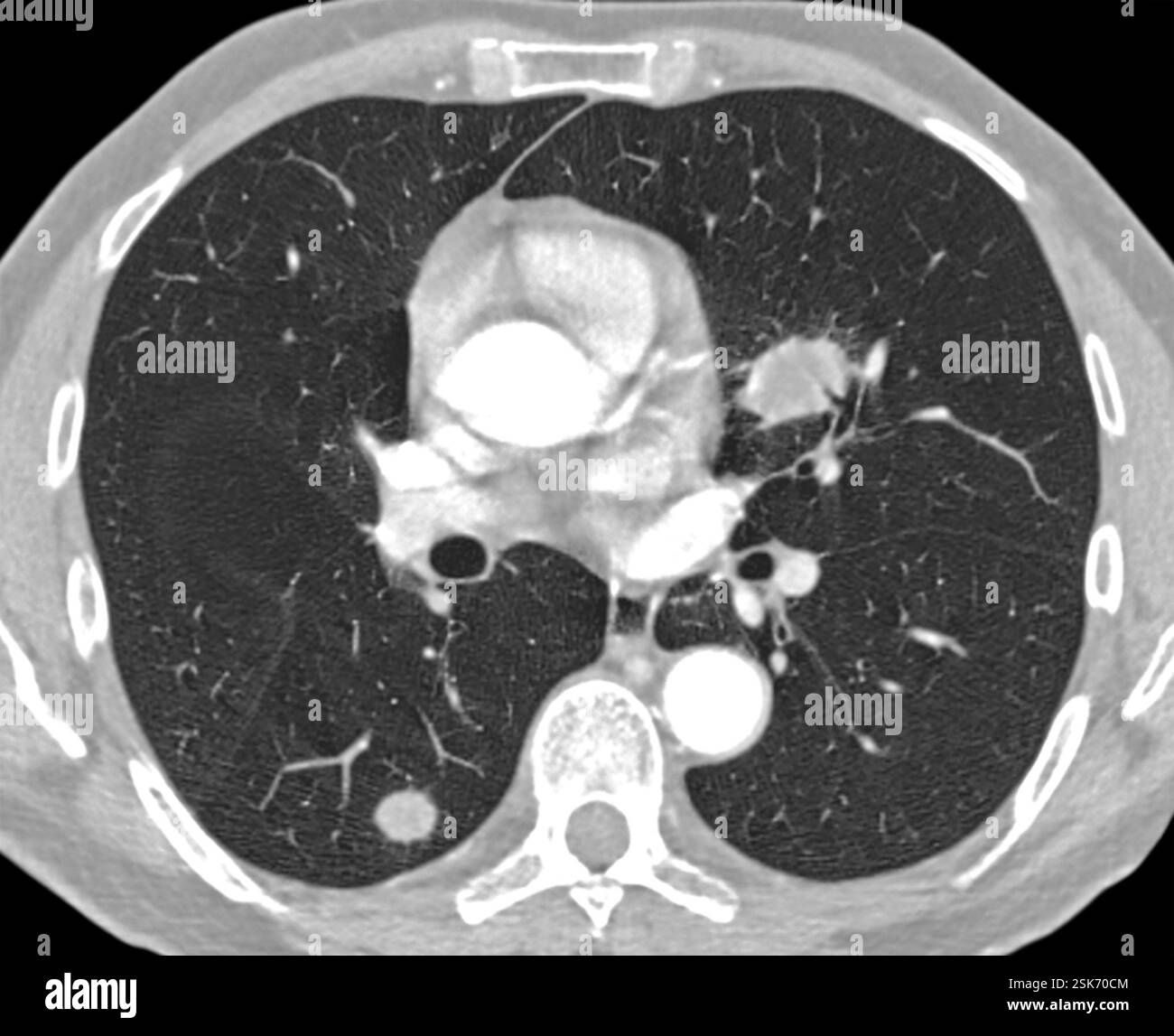 Wegener's granulomatosis. Axial chest computed tomography (CT) scan of ...