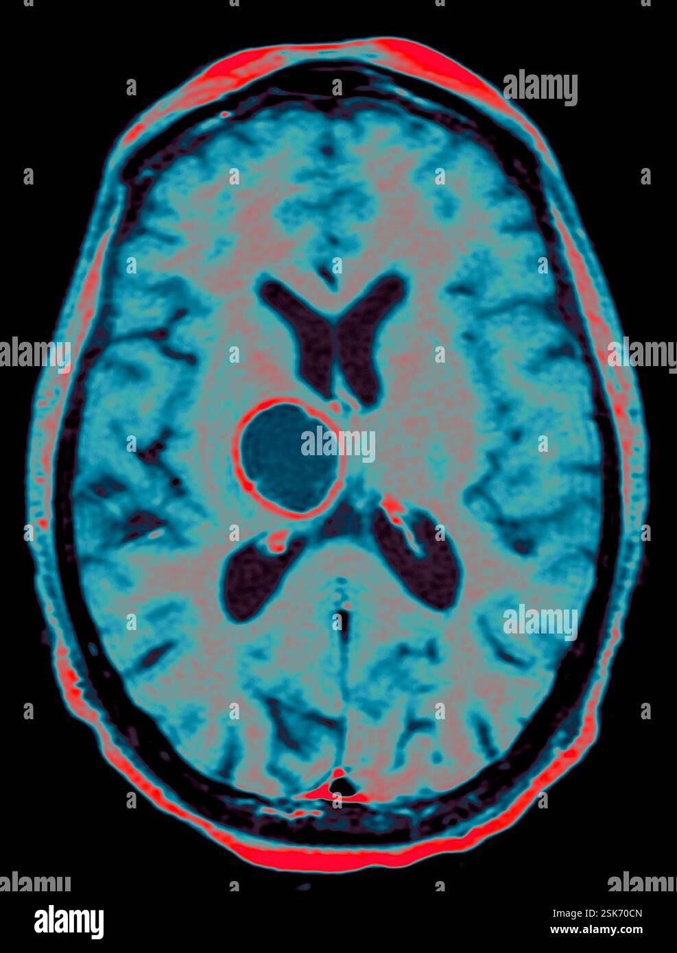 Secondary brain cancer. Coloured axial magnetic resonance imaging (MRI) scan through the brain ...