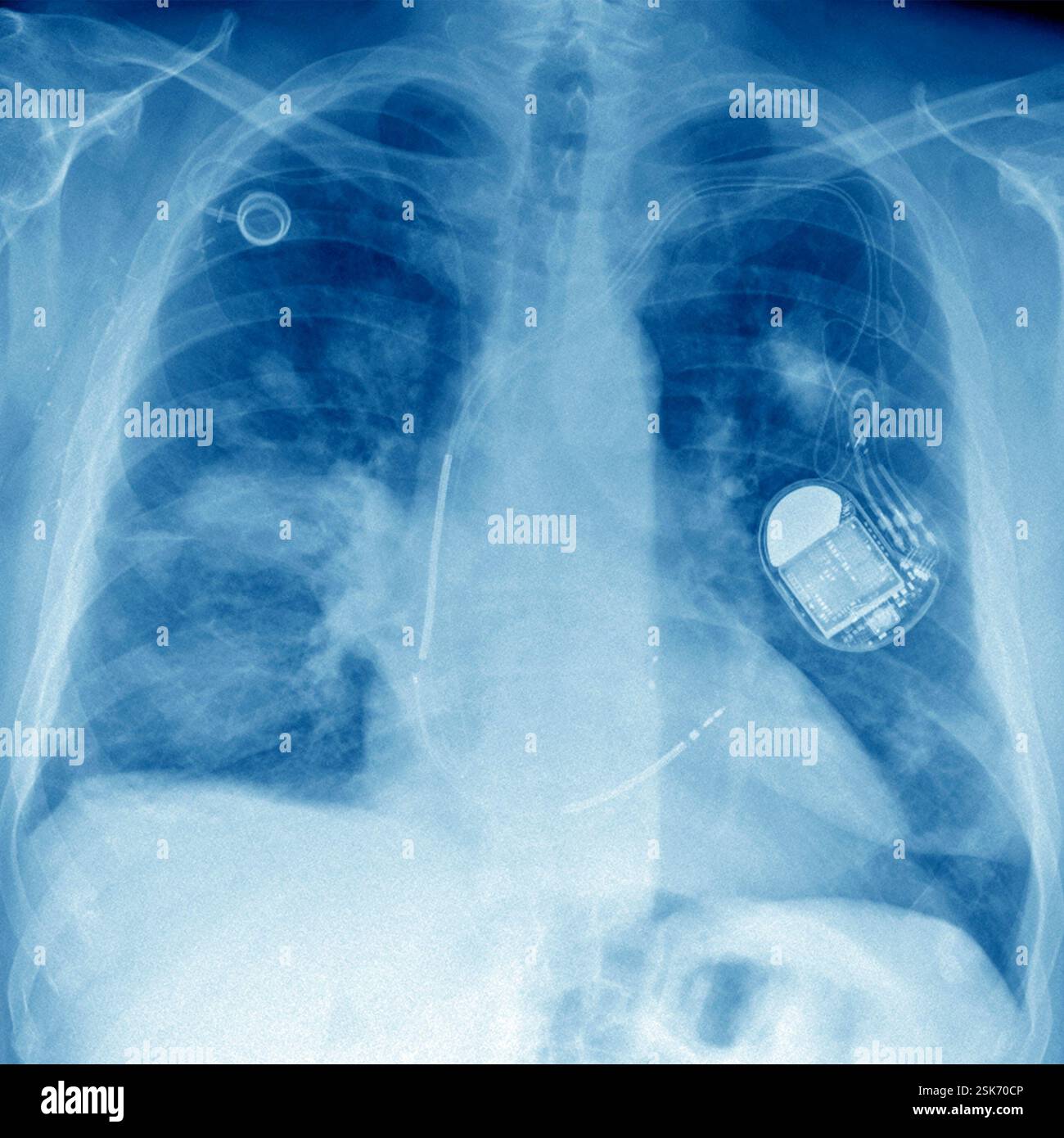 Secondary lung cancer. Frontal X-ray of the lungs of a 72-year-old man ...