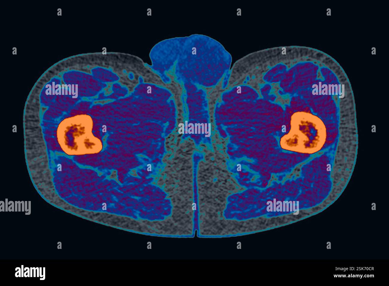 Testicular cancer. Coloured computed tomography (CT) scan of an axial ...