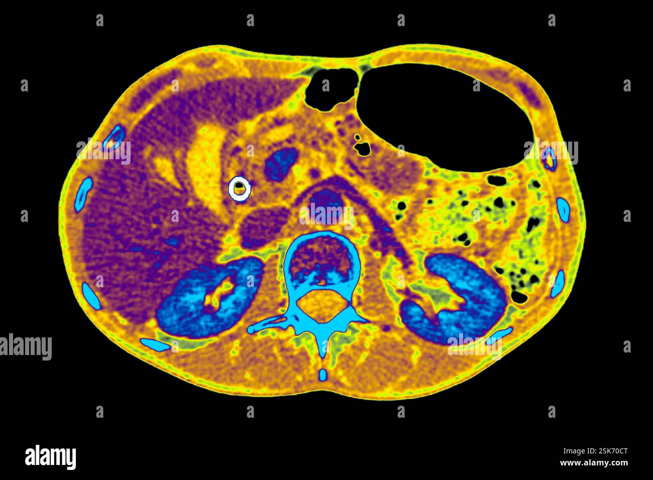 Common bile duct bypass in pancreatic cancer in a 60-year-old woman ...