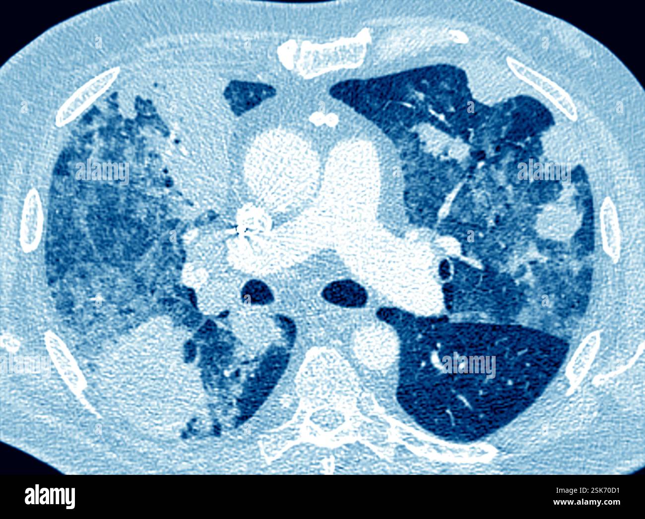Secondary lung cancer. Axial computed tomography (CT) scan through the ...