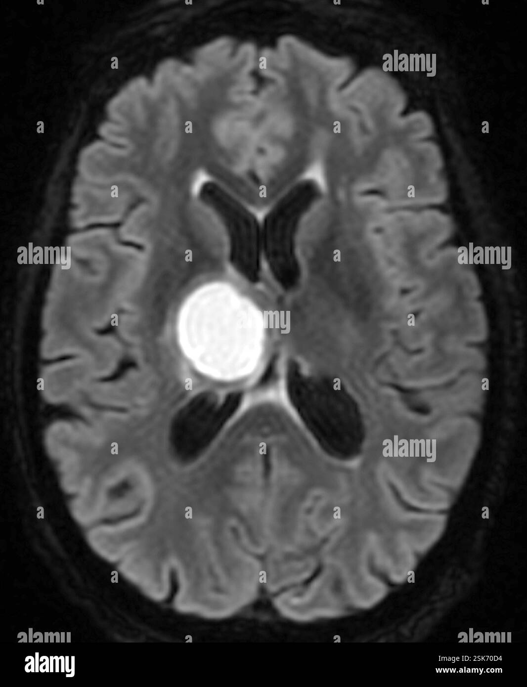 Secondary brain cancer. Axial magnetic resonance imaging (MRI) scan through the brain of a 55 ...