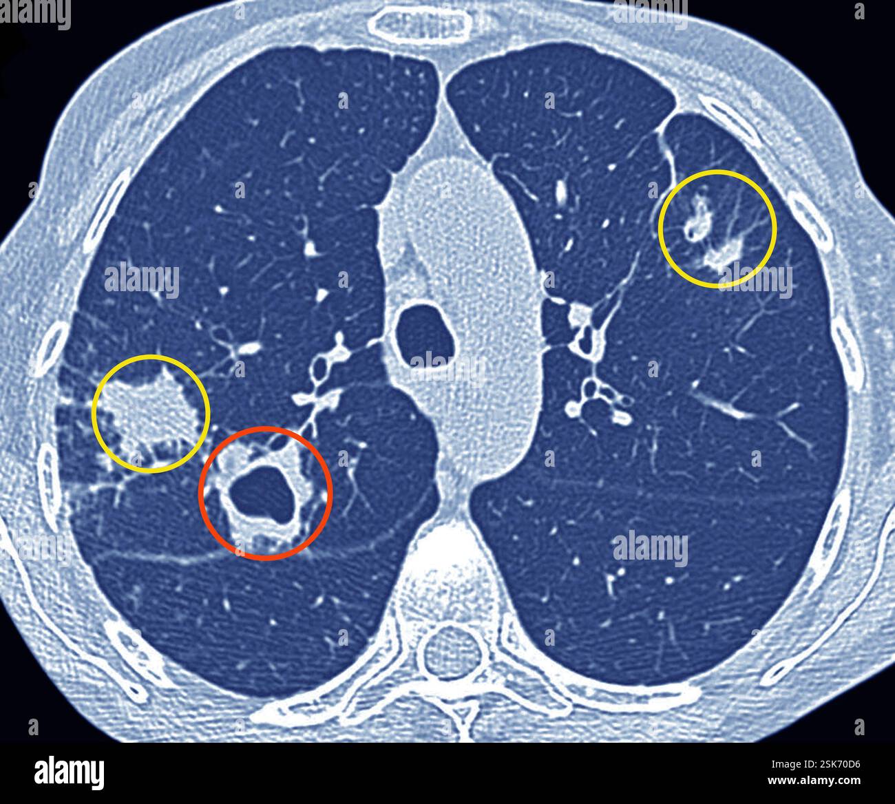 Wegener's granulomatosis. Axial chest computed tomography (CT) scan of ...