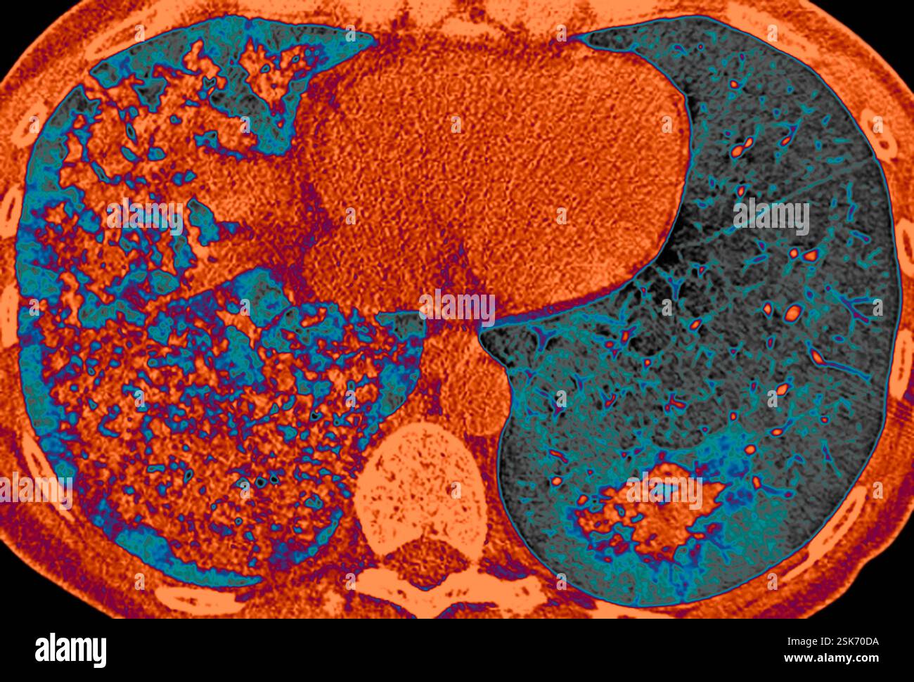 Wegener's granulomatosis. Coloured axial chest computed tomography (CT ...