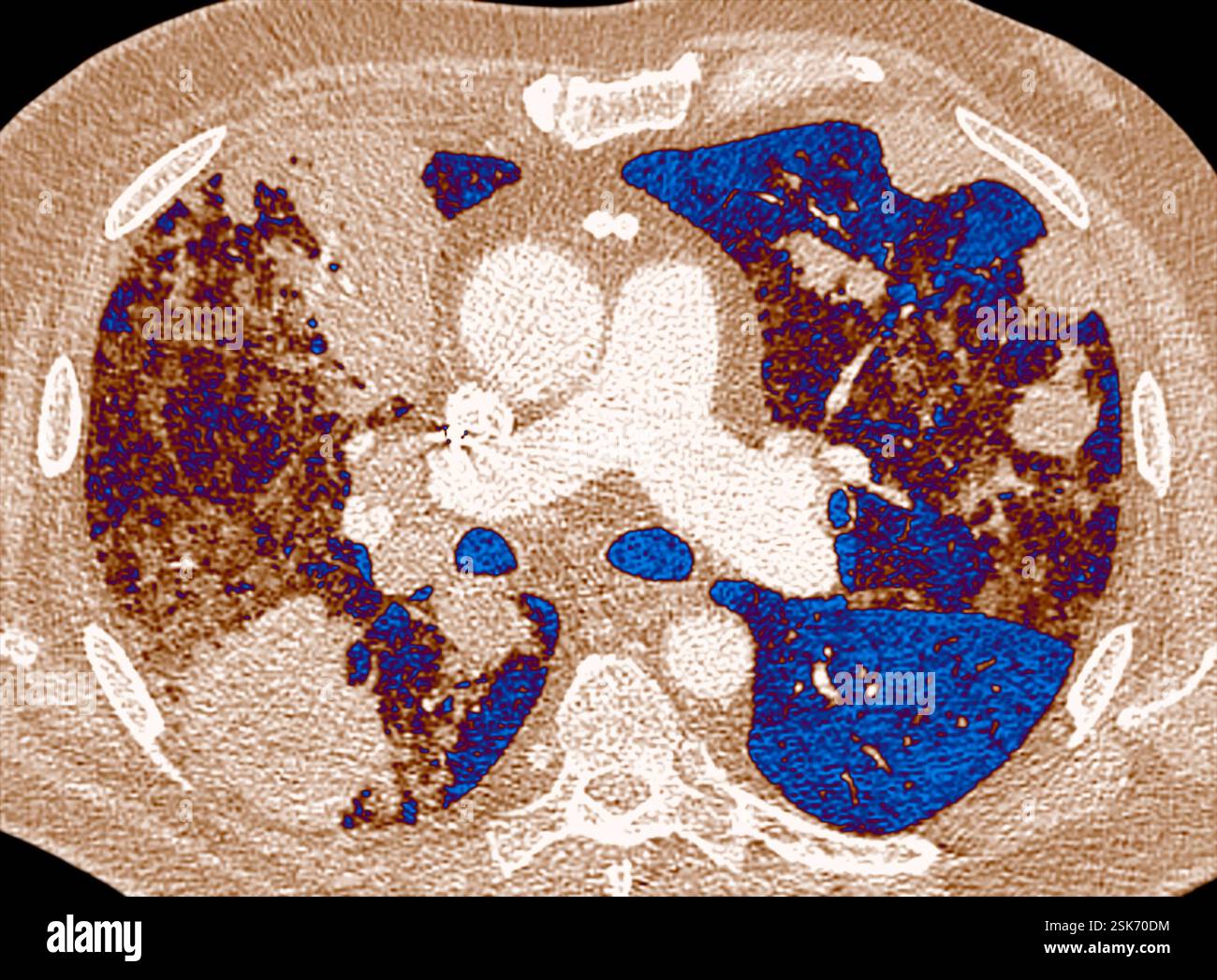 Secondary lung cancer. Coloured axial computed tomography (CT) scan through the chest of a 72 ...