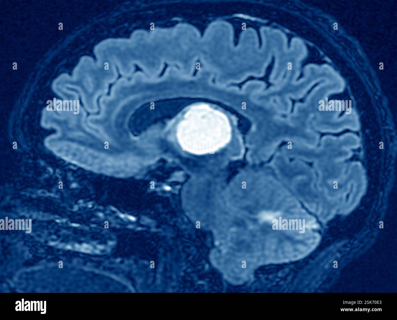 Secondary brain cancer. Sagittal magnetic resonance imaging (MRI) scan through the brain of a 55 ...