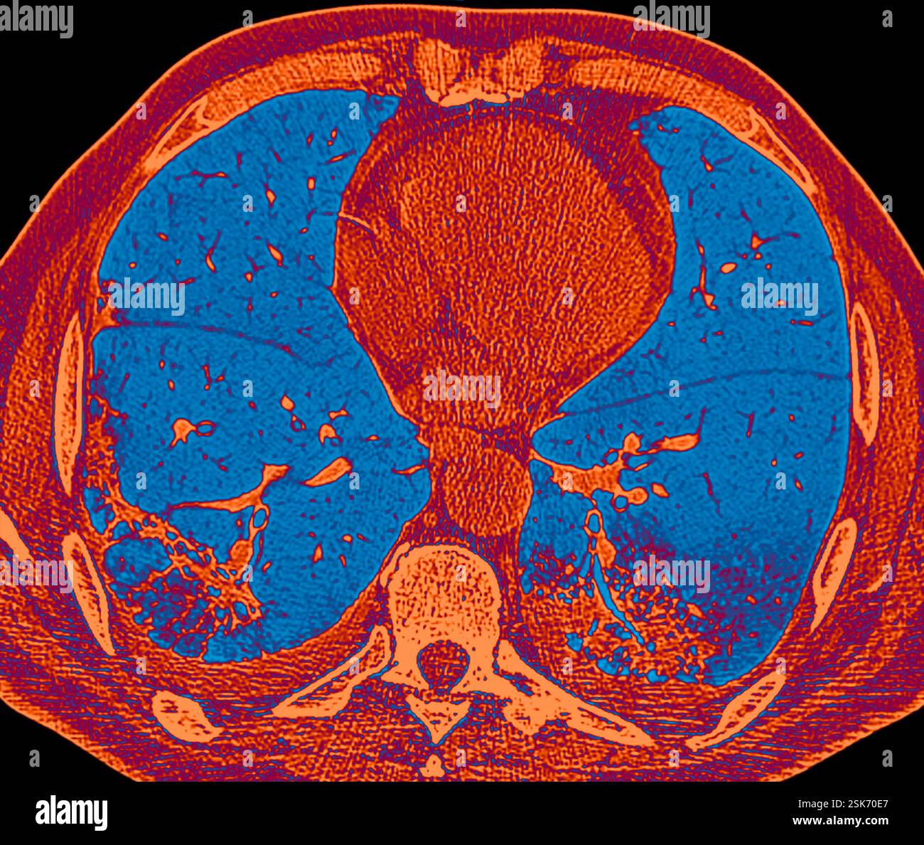 Organizing pneumonia. Coloured axial computed tomography (CT) scan ...